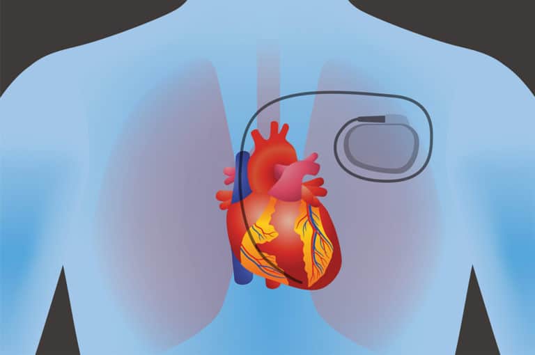Protecting Implantable Medical Devices From EMI Electromagnetic Interference